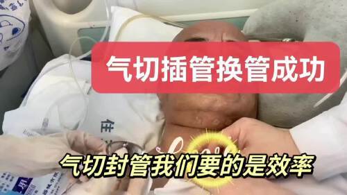 气切封管千千万我们要的是效率