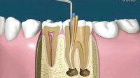 根管治疗(动画演示)