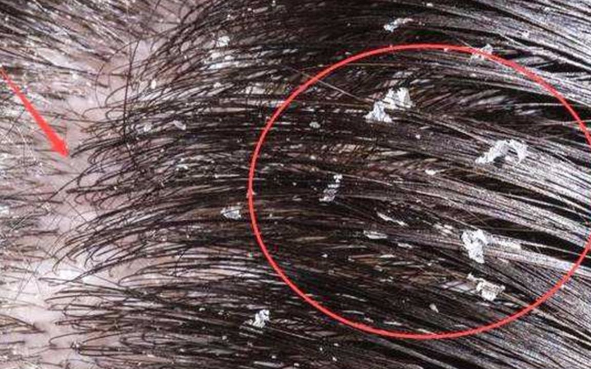 头皮屑对人体到底有多大危害?显微镜告诉你答案