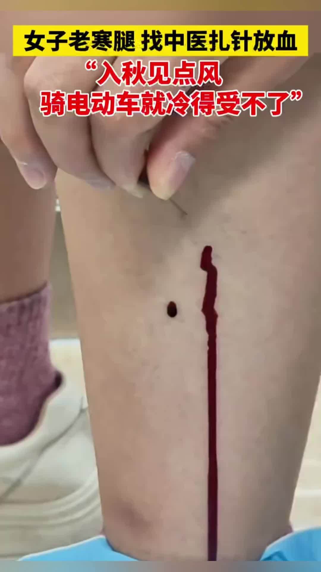女子老寒腿,找中医扎针放血