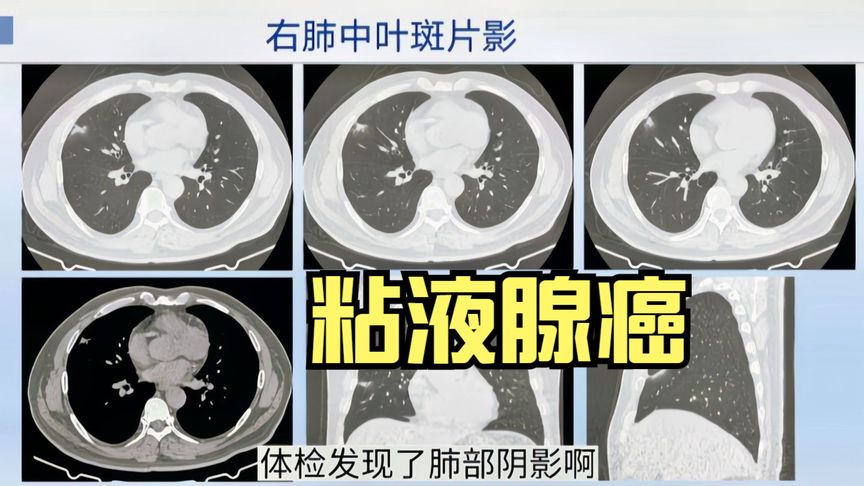抗生素能治疗肺癌吗?医生分享1种少见肺癌类型,早期常抗炎治疗