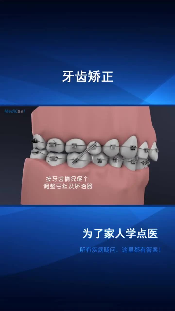 牙齿矫正是怎样的过程?3D动画演示正畸全流程!