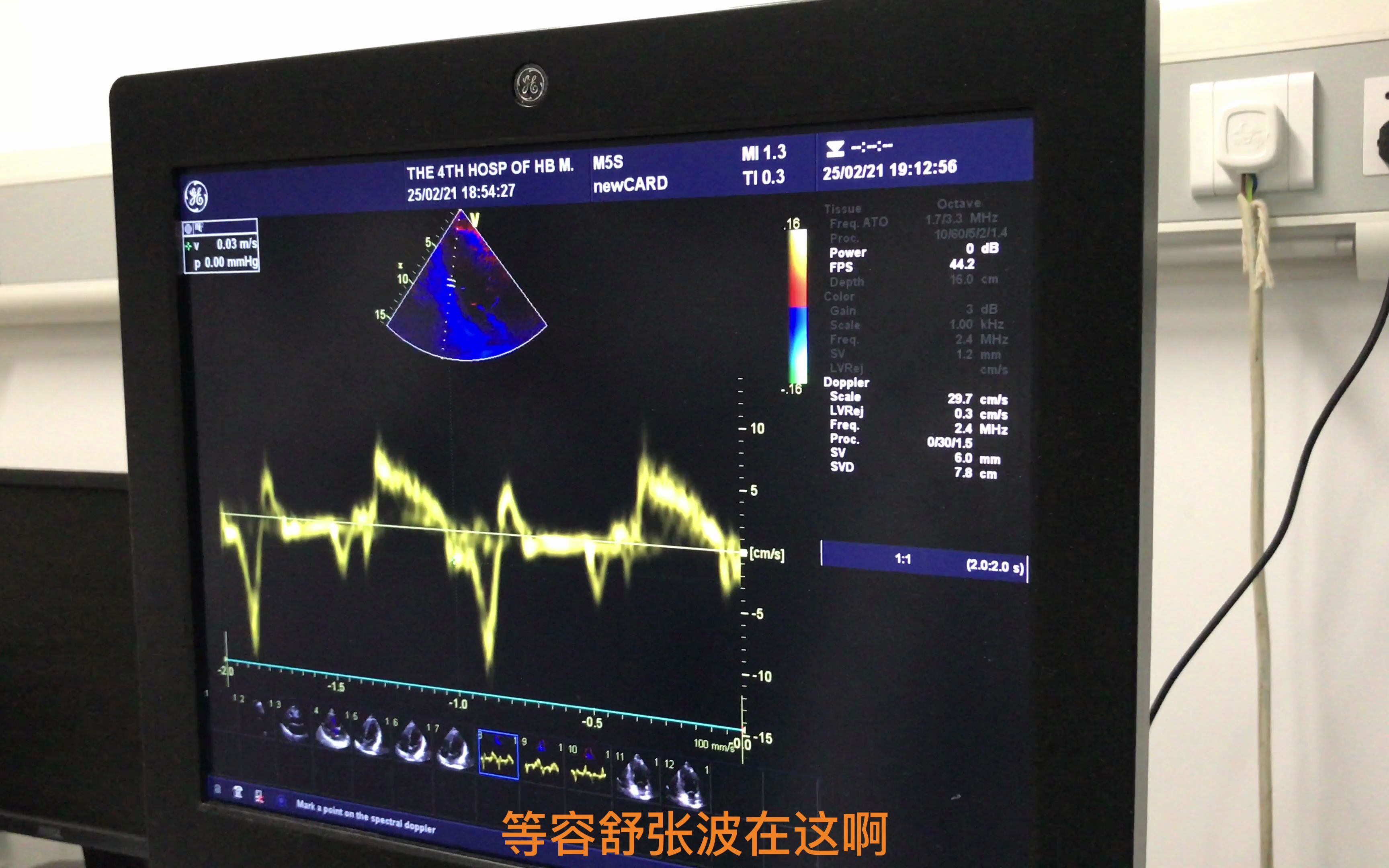 心脏超声入门教程2——心脏超声组织多普勒(TDI)讲解