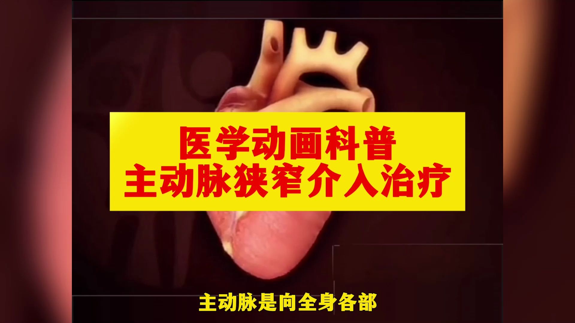 医学动画科普,主动脉狭窄支架介入治疗方式。