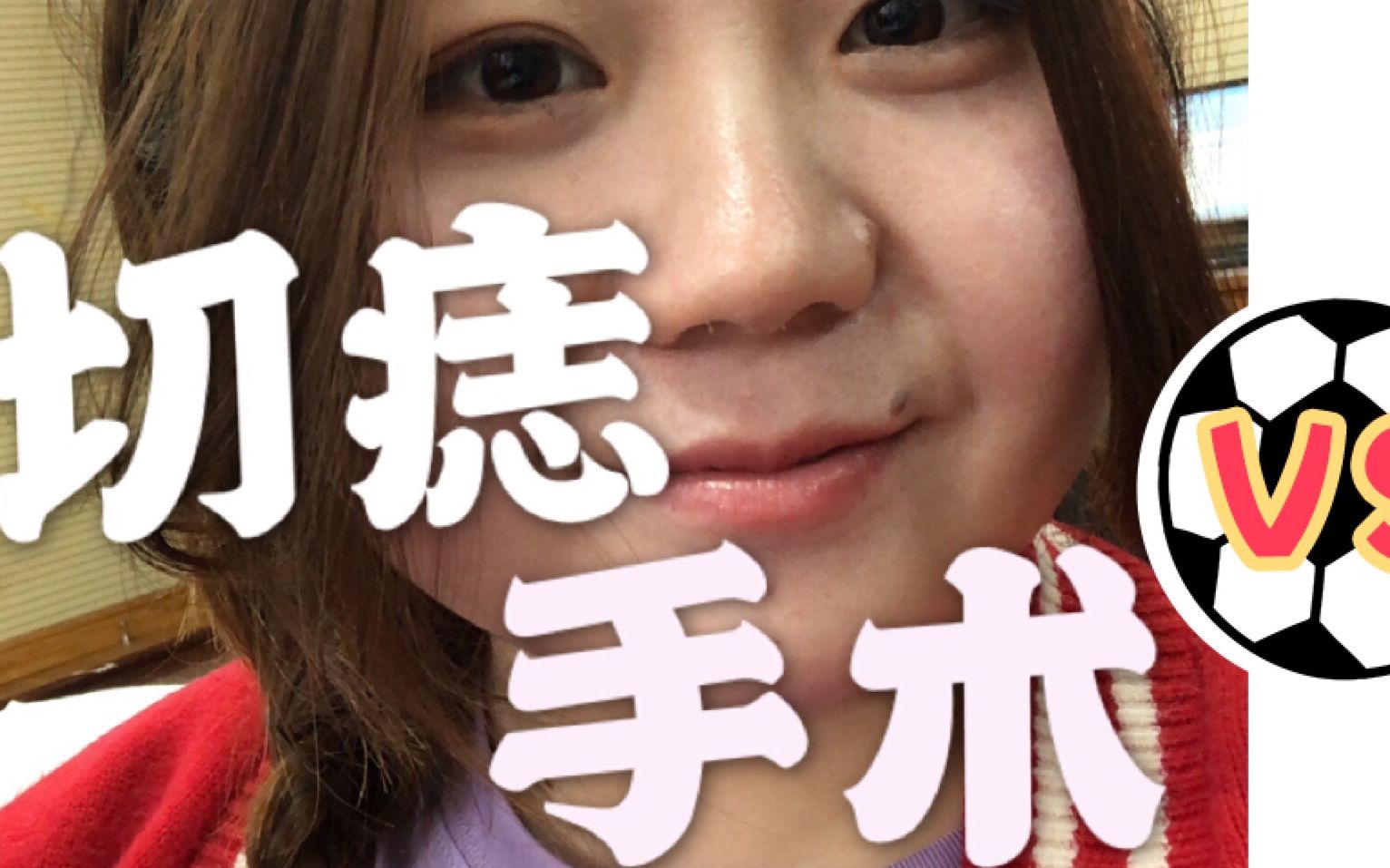 切痣手术前夜的兴奋与激动,记录下在我嘴角、鼻翼、下颌20多年的痣...