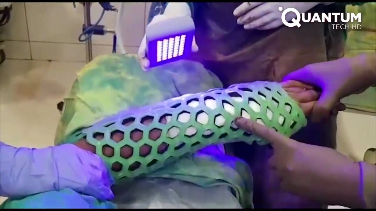 骨折了?打石膏不方便!再也不用打石膏了,黑科技固定技术,先进!
