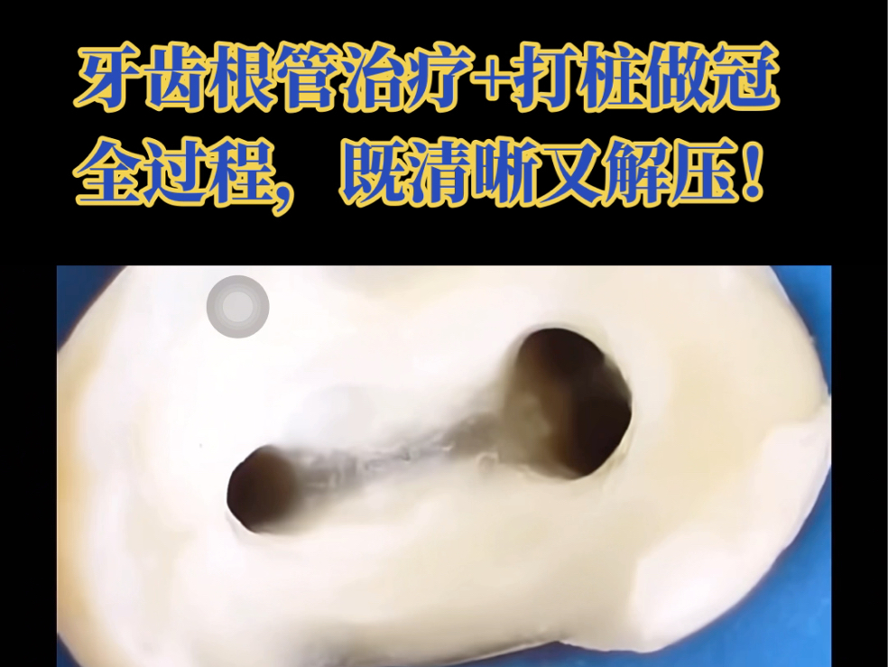 牙齿根管治疗和打桩做牙冠全过程