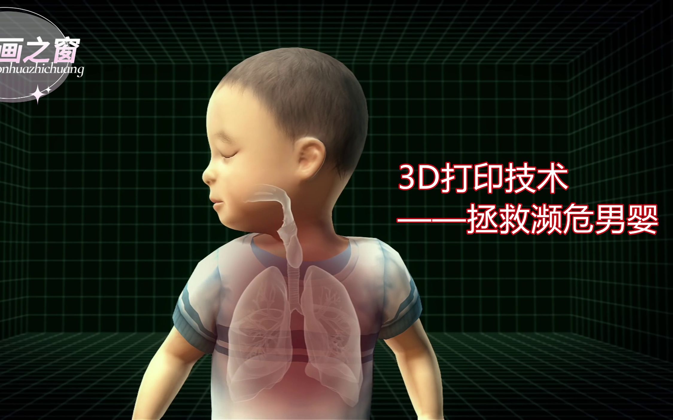 3D打印技术——拯救濒危怪病男婴,创造人类医学奇迹!