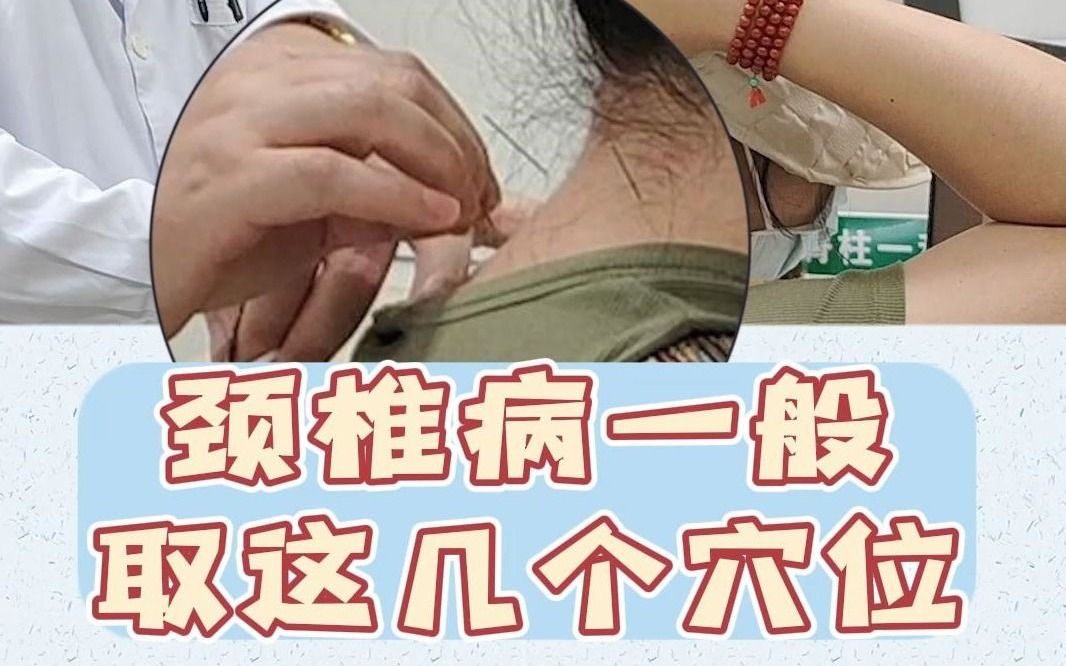 风池、肩井、颈百劳,针对颈椎病有效!