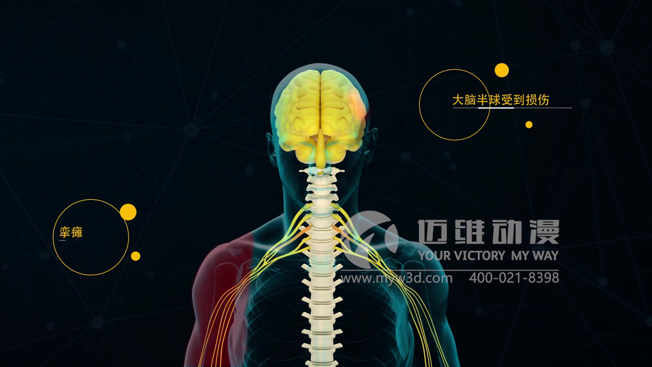 健侧颈7神经位移术医学动画-健侧颈7神经位移术三维动画过程
