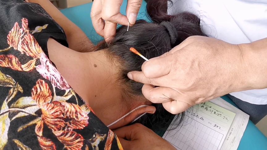 颈椎病脖子酸痛如何针灸?定位取穴很重要!项针疗法快速缓解疼痛
