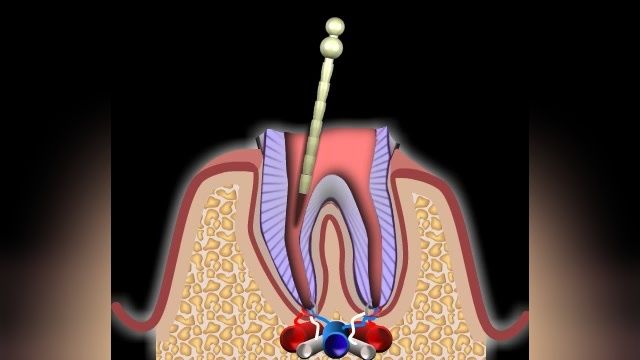 口腔修复学系列教学视频——桩冠5