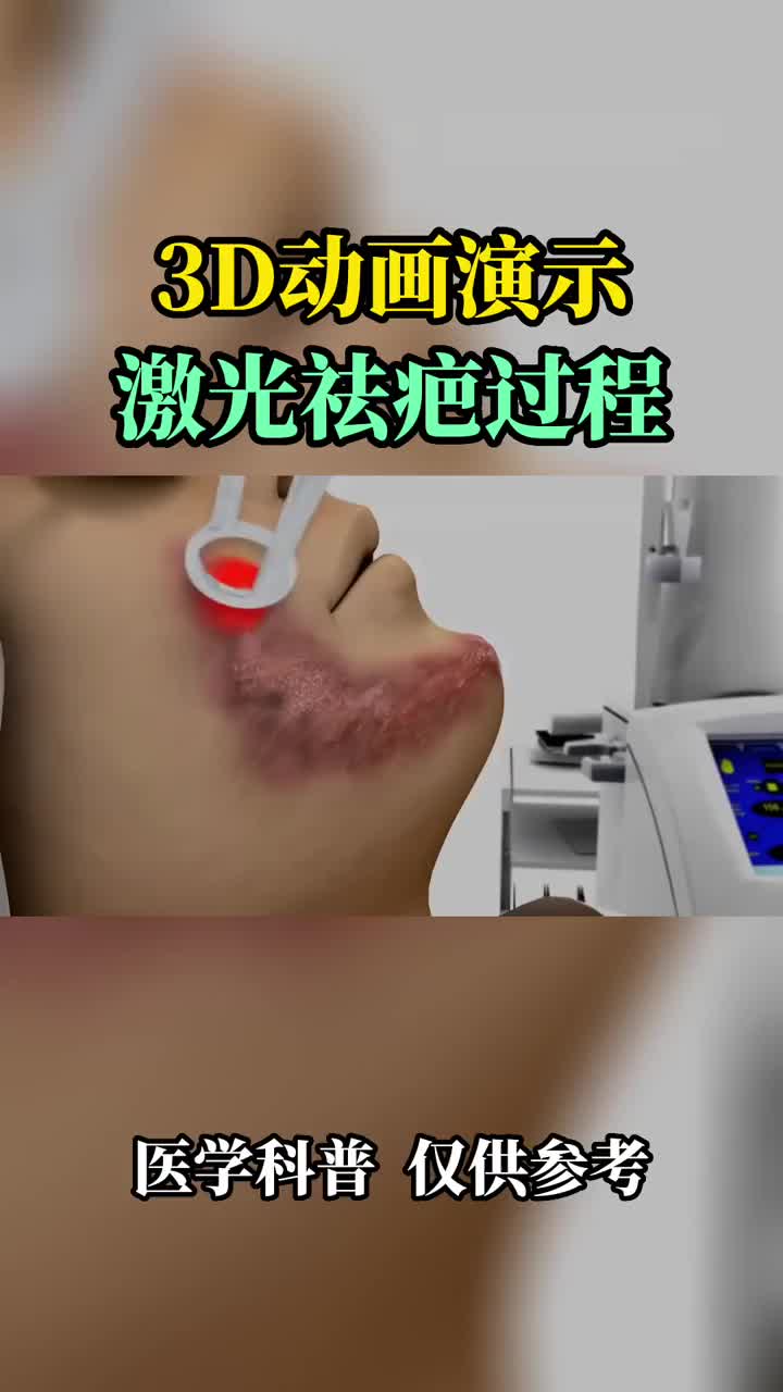 3D动画祛除疤痕过程【济南丽合】济南去疤痕医院