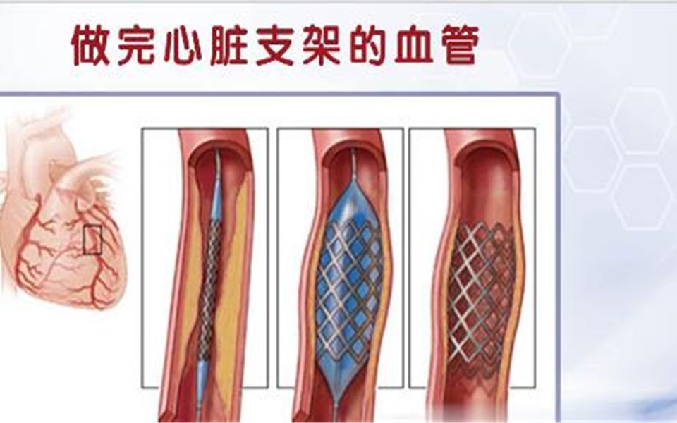做心脏支架后,血管又堵塞?专家对症下药,消斑块根治冠心病