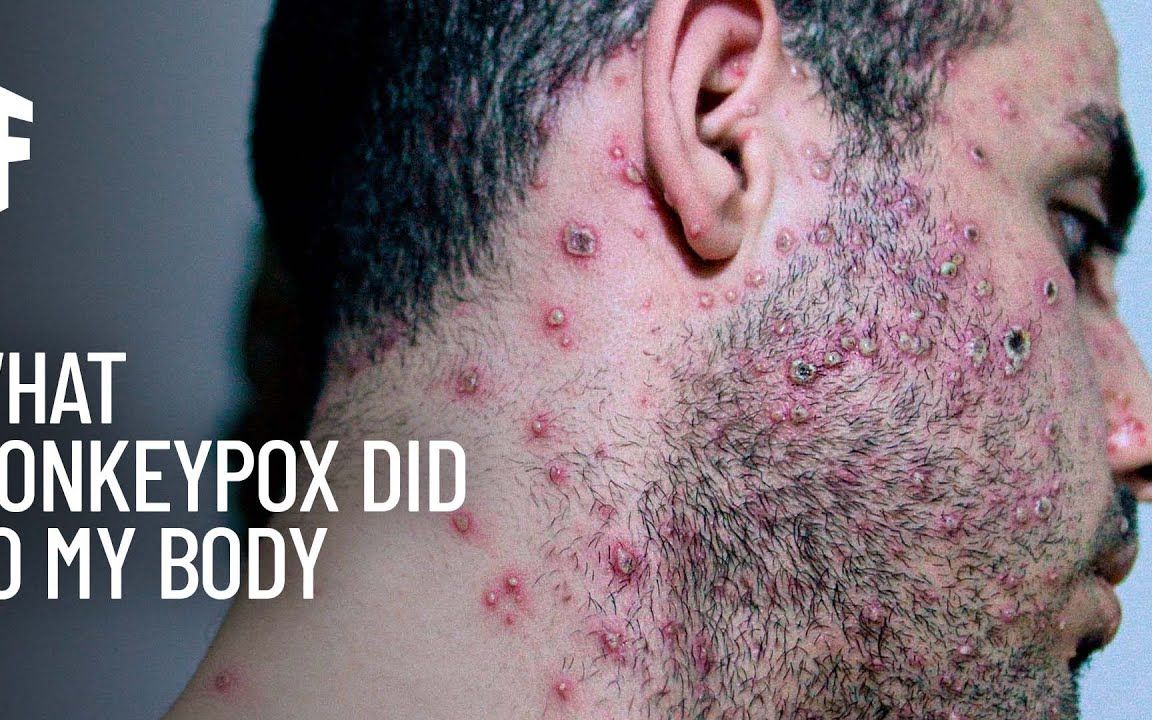 猴痘:它如何伤害我们的身体? | 双语字幕 | 医学动画 | 医学英语
