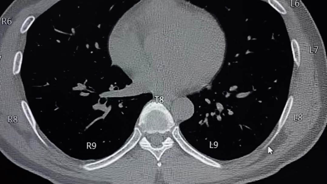胸部CT 肋骨计数