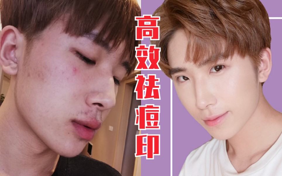 【TUTU】2个妙招让你快速去掉痘印|高效祛痘印方法大分享