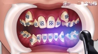 雅莱齿科正畸全过程视频