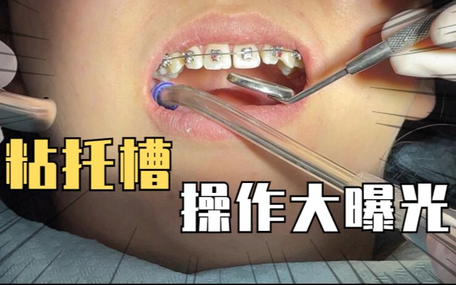 金属托槽怎么粘?操作流程大曝光!