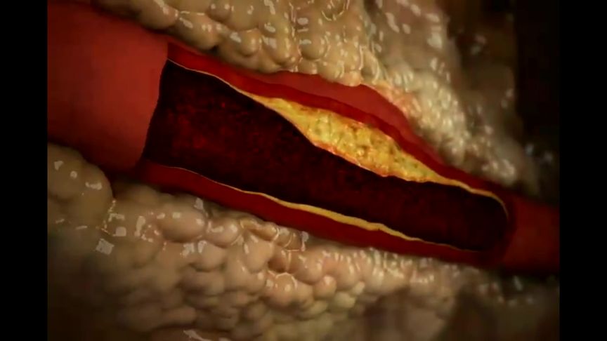 医学3D动画演示:斑块脱落导致脑梗死及心肌梗死是如何发生的