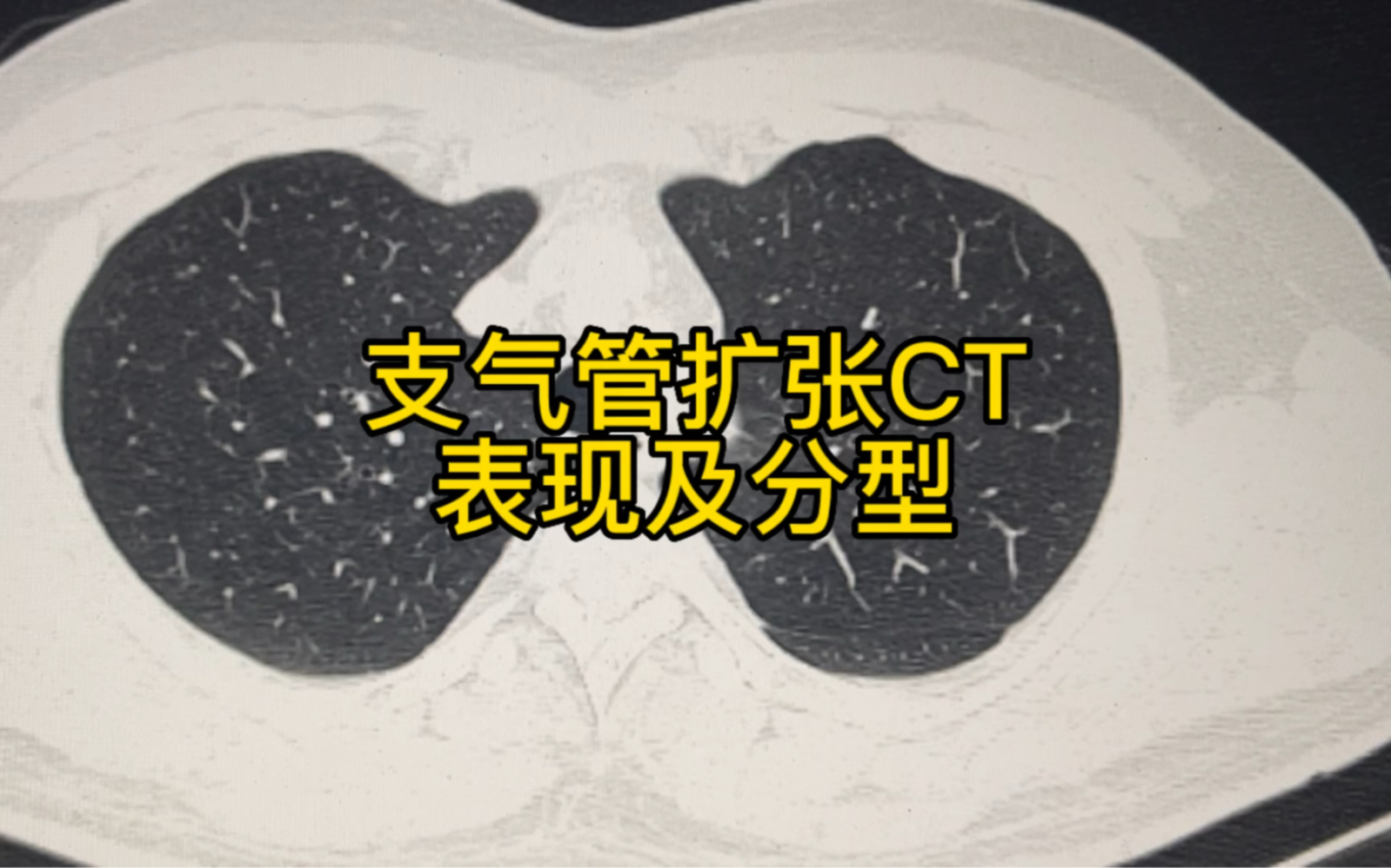 支气管扩张分型及影像学CT表现