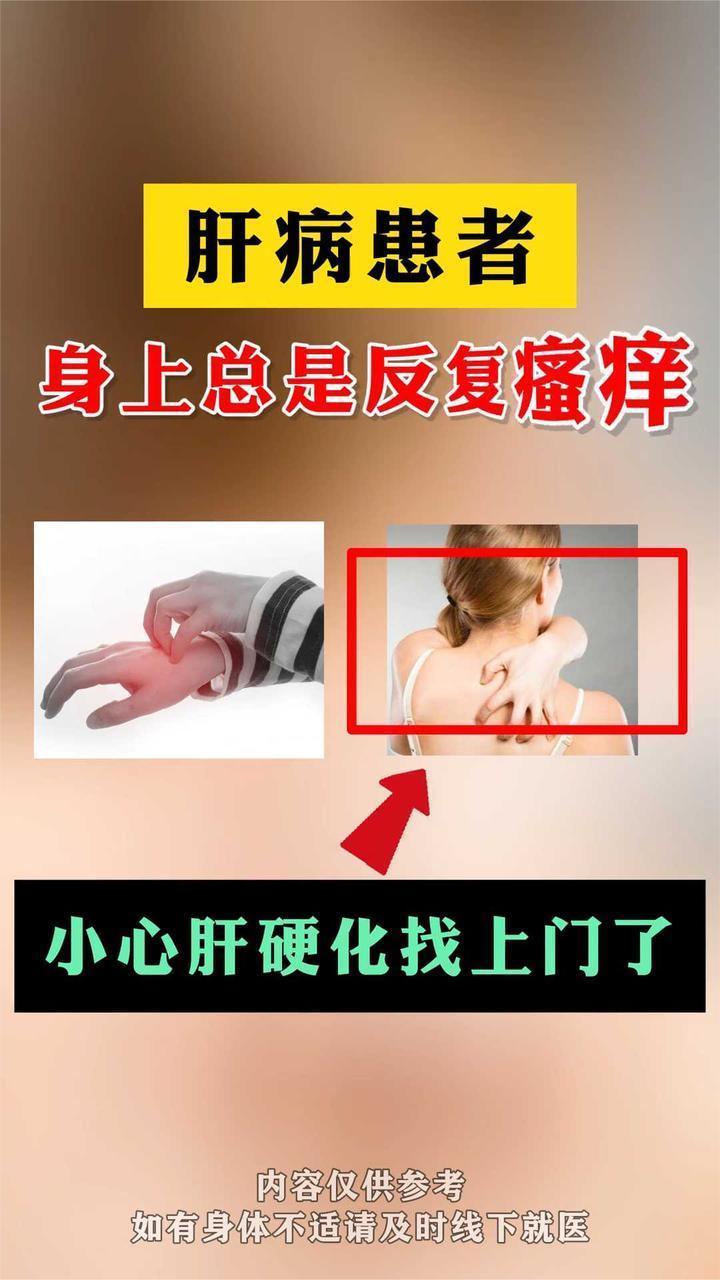 身体反复瘙痒?赶紧看看肝病,这类肝硬化你是否忽视了!