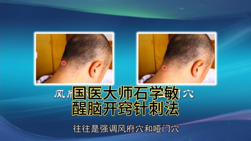 国医大师石学敏讲醒脑开窍针刺法 ,风府穴哑门穴