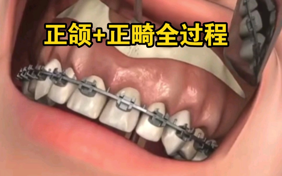 正畸+正颌全过程,胆小者慎入!