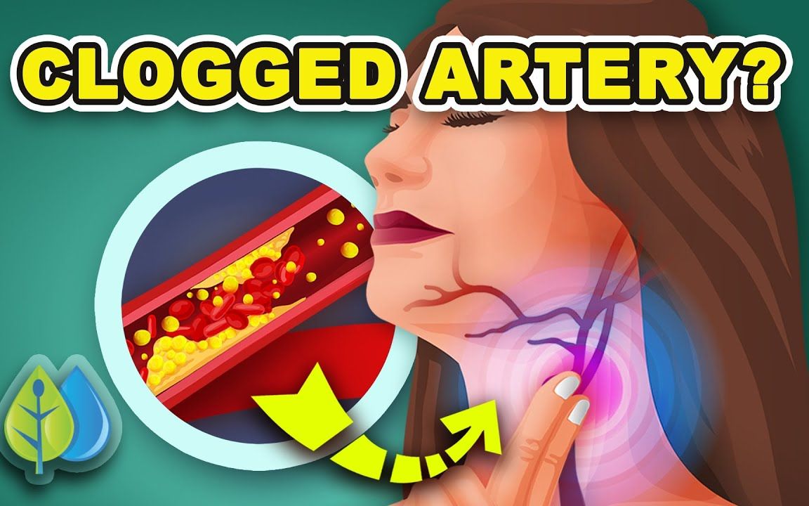 清除阻塞动脉的 1 种独特方法