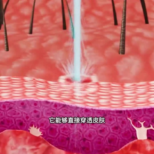 无针注射的实际工作原理,它能够直接穿透皮肤,将药物喷入肌肉中