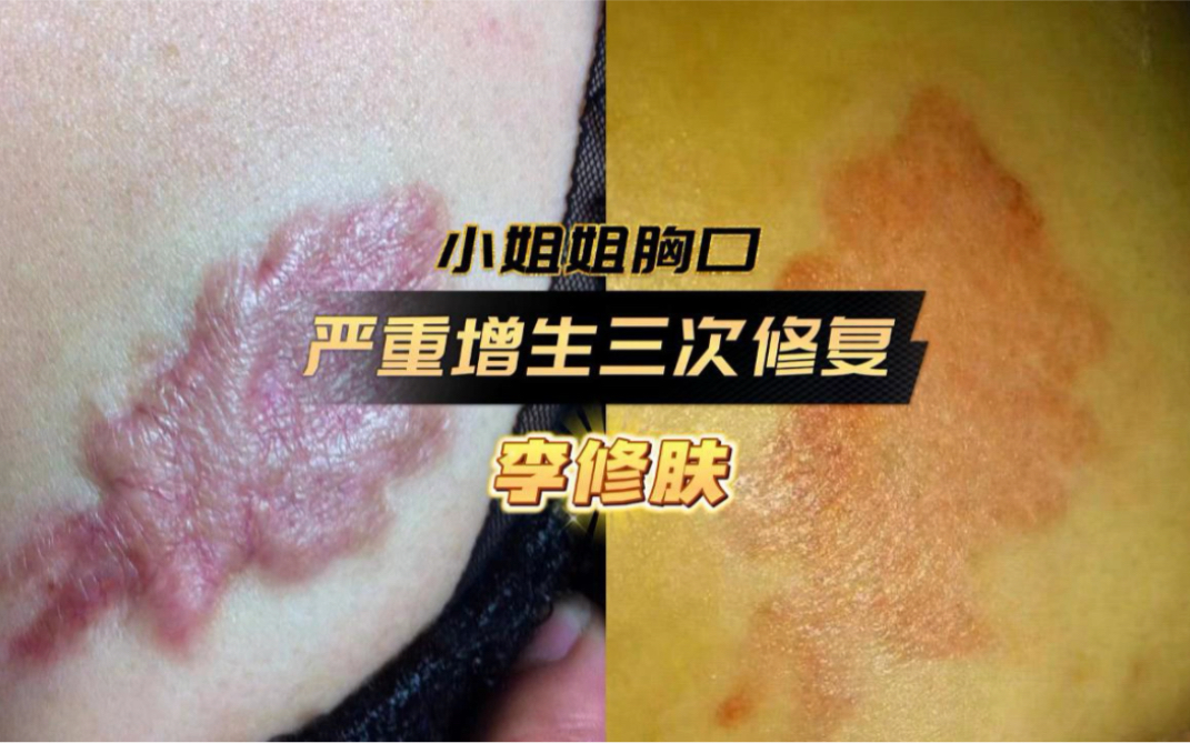昆明李修肤洗纹身,纹身疤痕修复真实全过程!