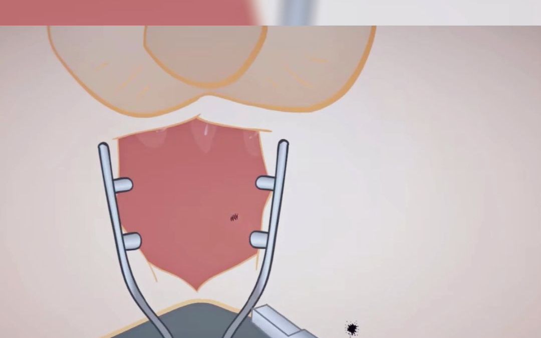 3D动画演示:肛瘘治疗