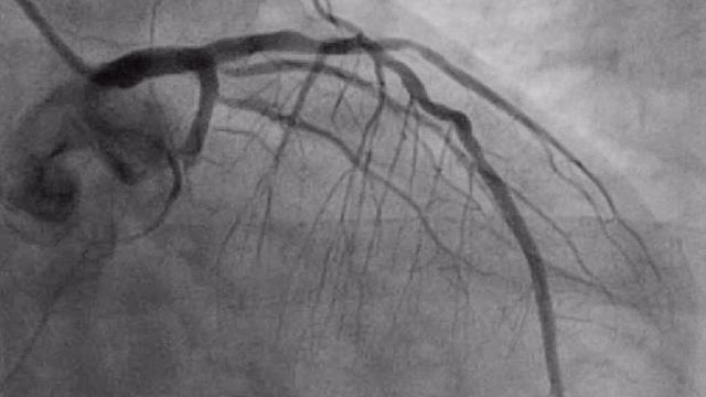 一位心肌梗死患者的冠状动脉造影真实视频