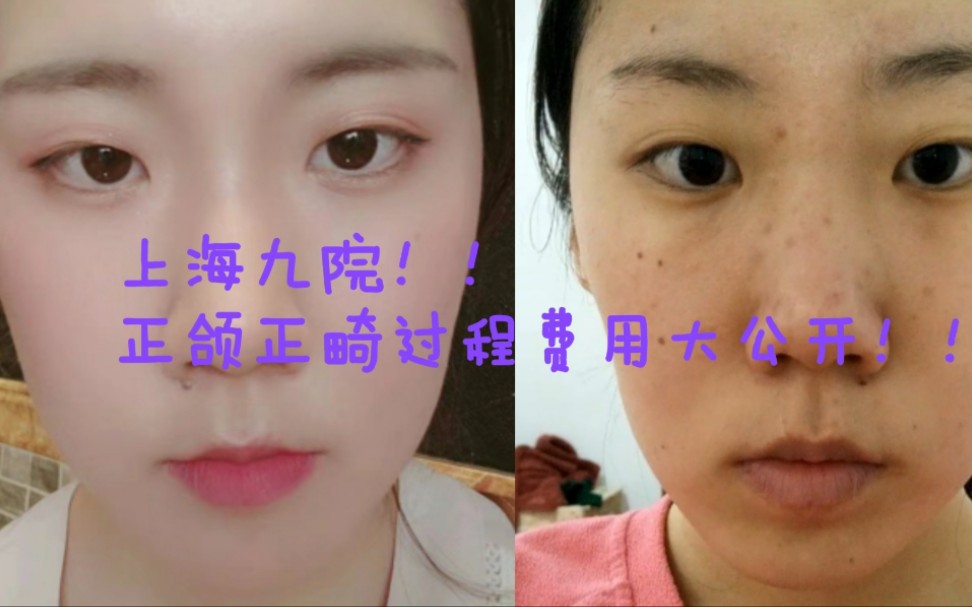 唠嗑型up在上海九院正颌正畸的详细过程以及费用大公开!宝贝们进来...