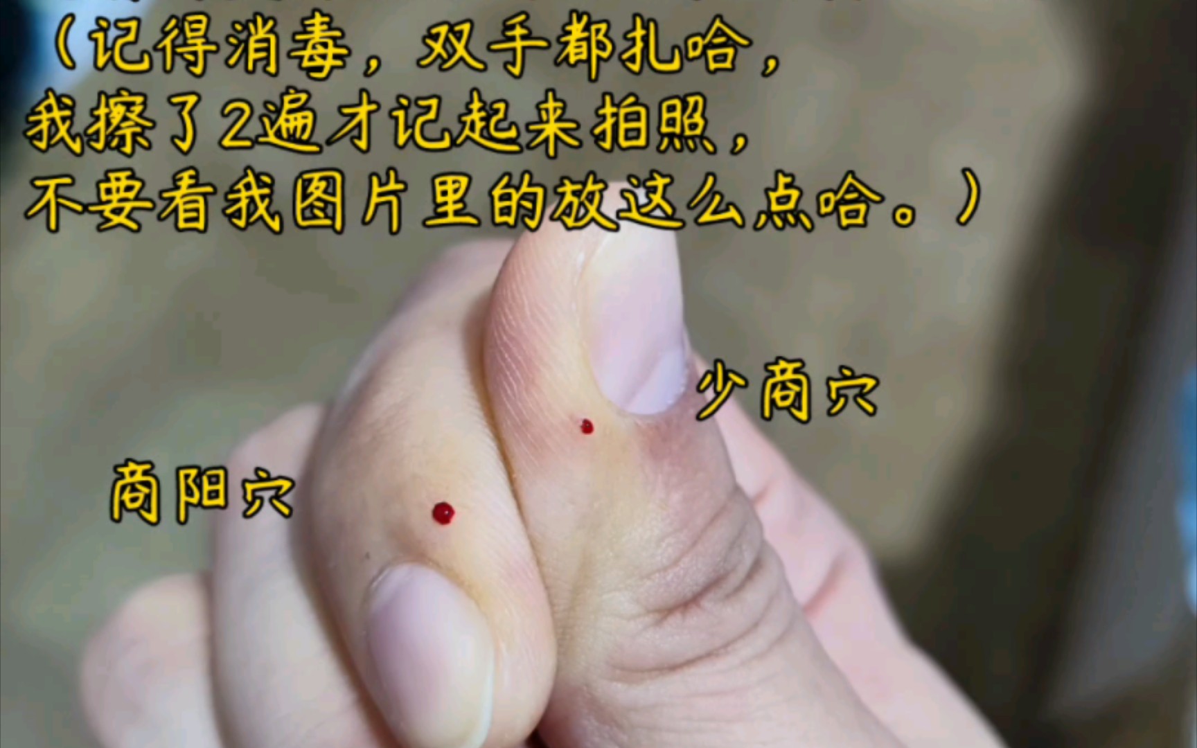 ...新冠做好准备发热、咽喉疼的宝们,除了吃药、硬抗,还有针灸辅助治疗...