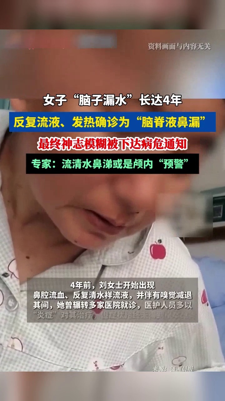 女子"脑子漏水"长达4年,反复流液、发热,神志模糊险丧命