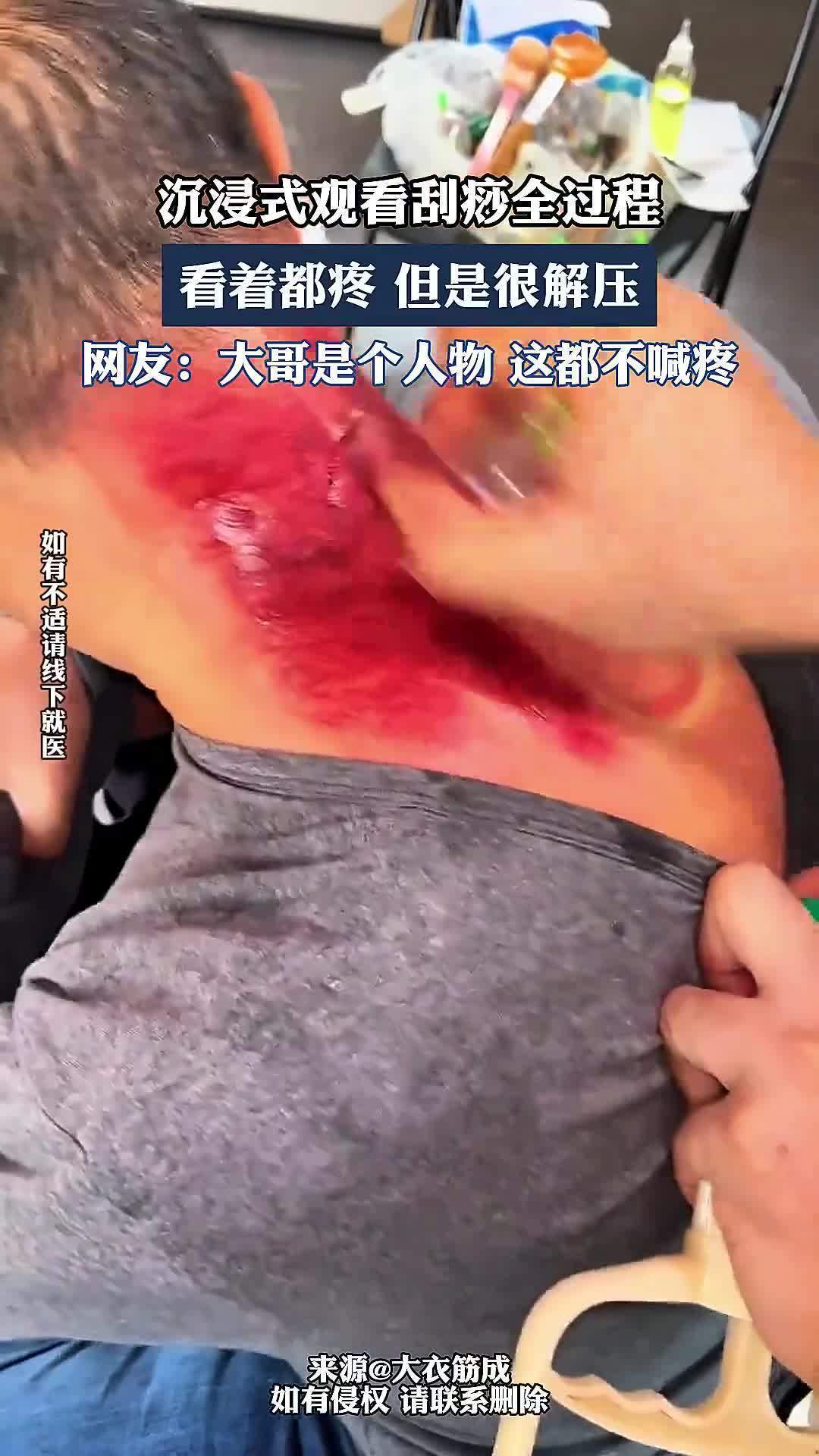 沉浸式看刮痧全过程,看着疼但超解压!