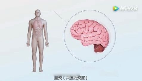 ...动画演示艾滋病毒感染过程及发病,珍爱生命洁身自爱安全套_腾讯视频