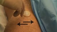中心静脉置管之股静脉穿刺(NEJM)