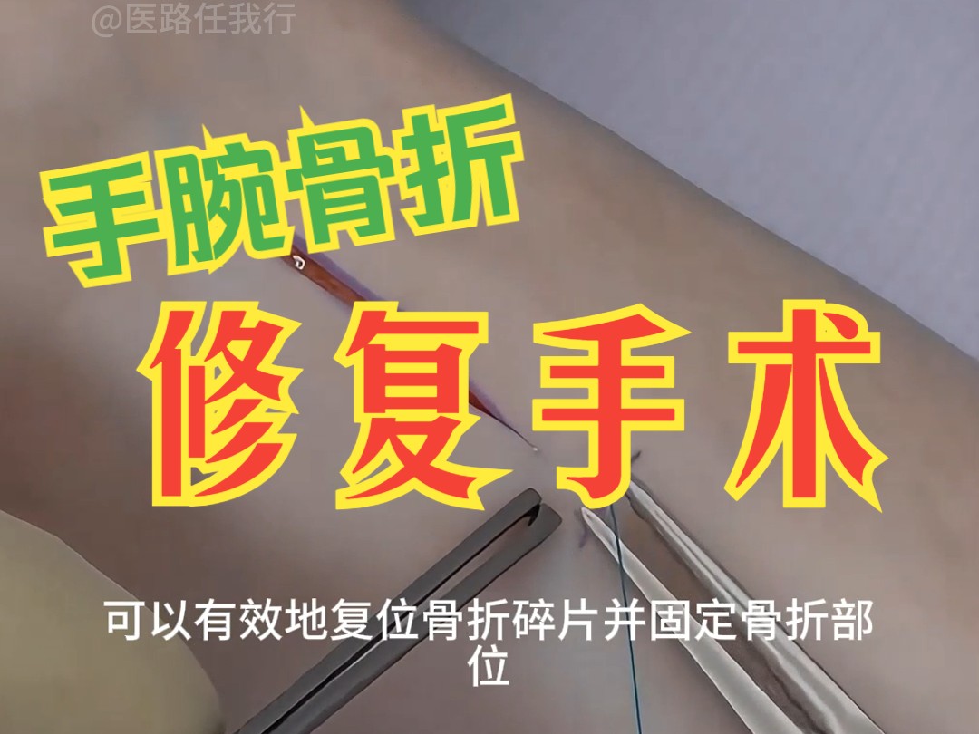 【高清】桡骨远端手腕骨折修复手术3D动画