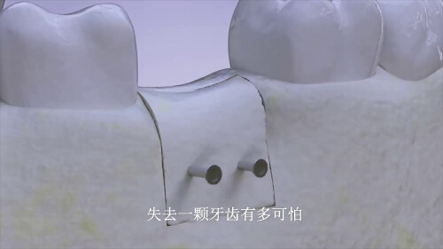 失去一颗牙齿有多可怕?3D动画演示5年后的变化,长知识了!