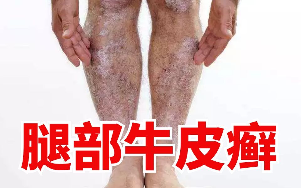 男子双腿被青紫色牛皮癣覆盖,找到医生全面调理,消退明显