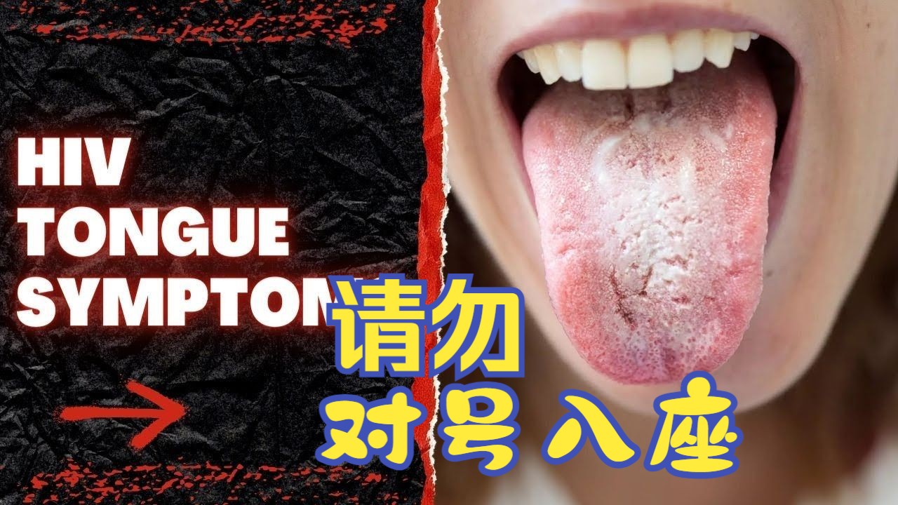 HIV 感染者的舌头