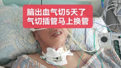 脑出血气切插管,找我第五天了,马上开始气切插管换管