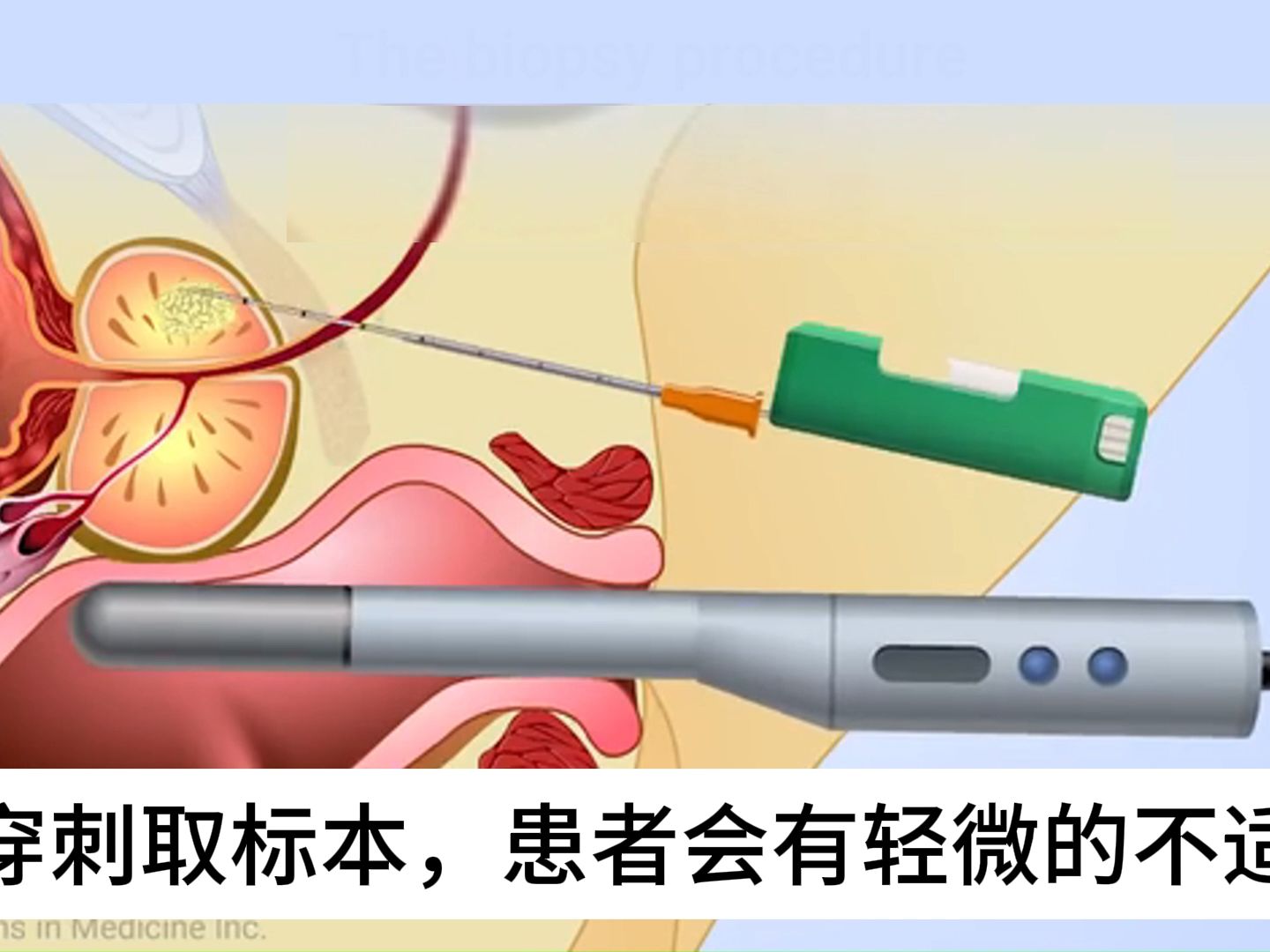 男人不能说的痛,前列腺穿刺的过程,做过的人来说说,什么感觉。