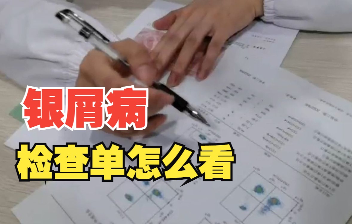 银屑病的检查单该怎么看?主任教你如何确定治疗方案!