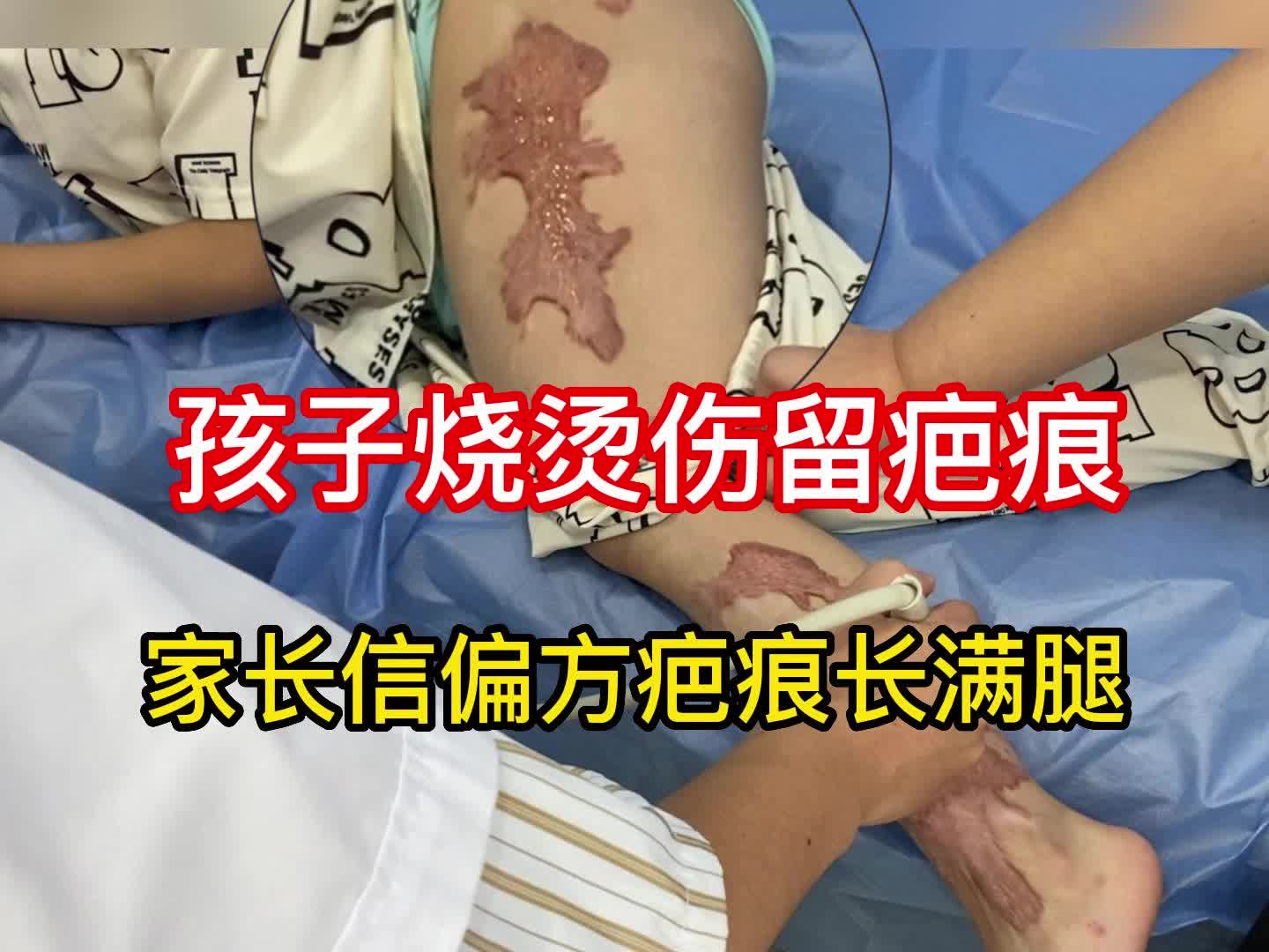 烫伤后不要轻信“偏方”,刺激疤痕生长变成了一层“棉毛裤”