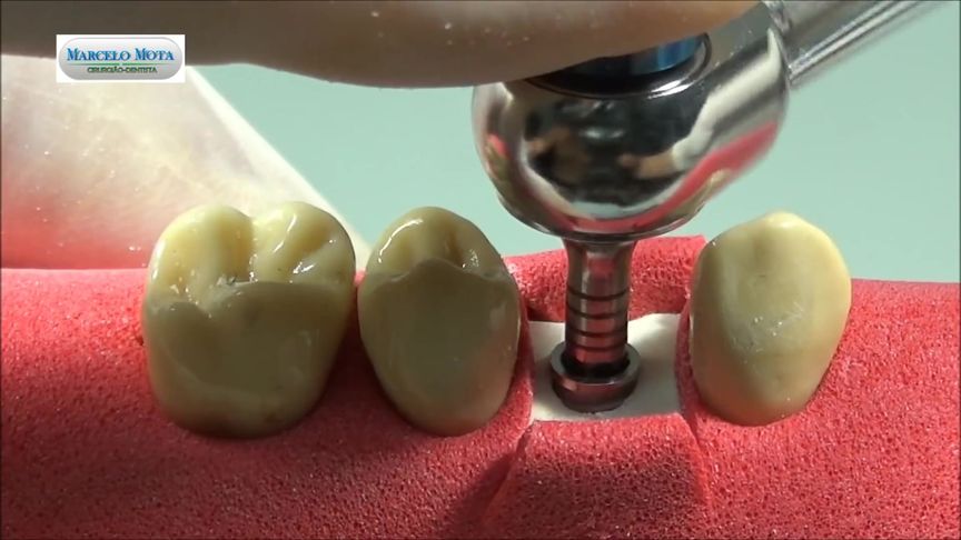 8倍速模型演示种植牙过程