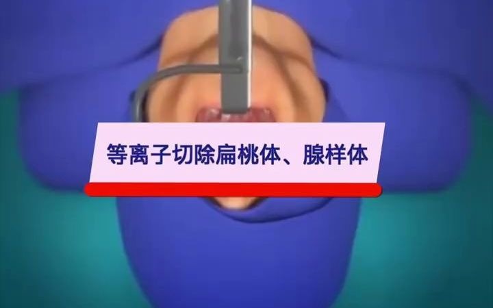 低温等离子切除扁桃体、腺样体