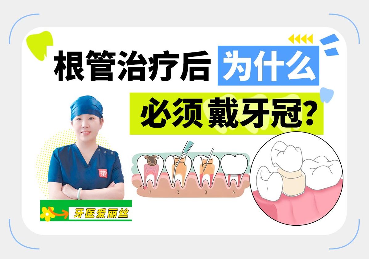 根管治疗后戴牙冠是不是智商税?到底是不是必需要戴牙冠?